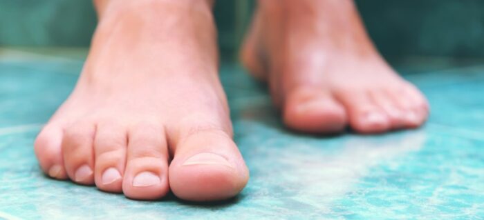 Nail Fungus and Swimming Pools - Toenail Fungus Treatment Center