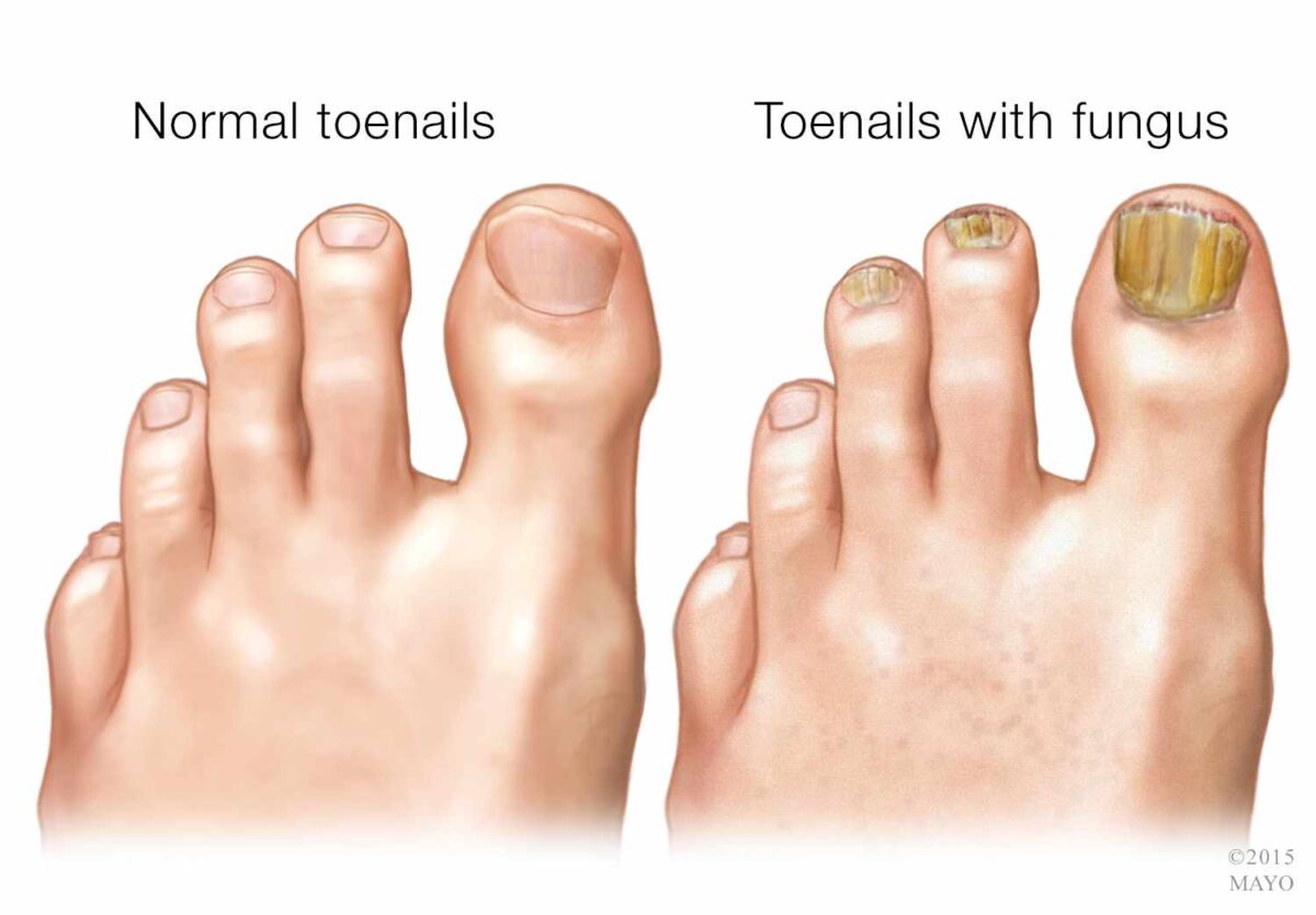 Is Psoriasis Toenail Fungus? - Toenail Fungus Treatment Center